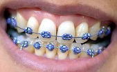 Braces, Invisalign, Lingual braces, Speed braces Which One To Choose? 2