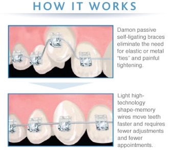 Braces, Invisalign, Lingual braces, Speed braces Which One To Choose? 2